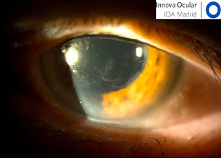 Miranza IOA: DISTROFIAS CORNEALES: Distrofia de Cogan