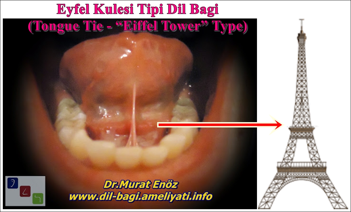 Eiffel Tower Type Tongue Tie Release Operation