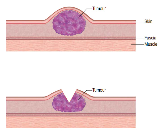 Biopsia incisional y biopsia escisional | Servicio de Anatomía ...