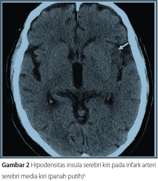 Gambaran CT Scan Non-Kontras pada Stroke Iskemik ~ Seputar Kedokteran