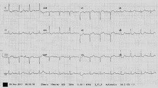 ECG of the Week: ECG of Week - 13th Feb 2012 - Interpretation