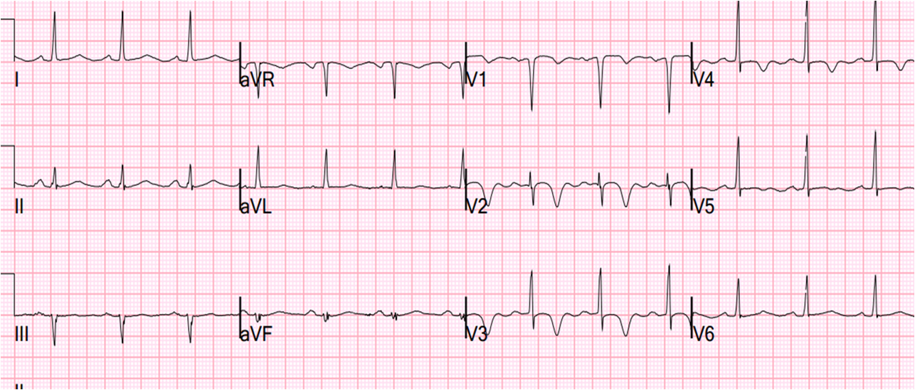 Dr. Smith's ECG Blog: Septal STEMI with lateral ST depression, then has ...