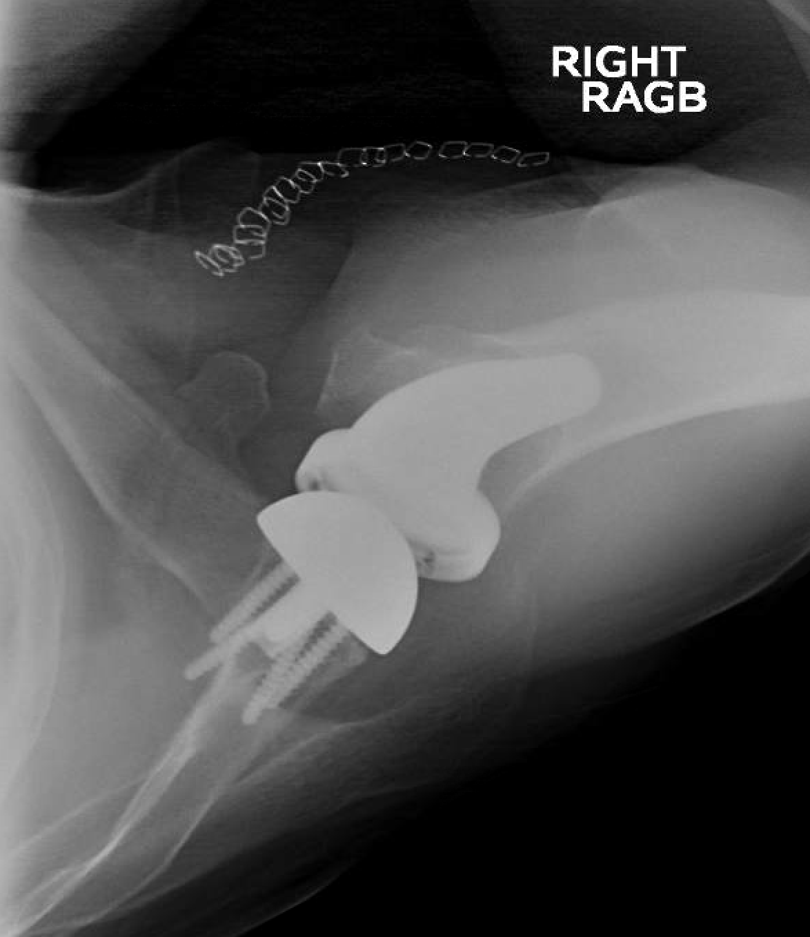 Shoulder and Elbow Surgery: The ideal position of the glenosphere in ...