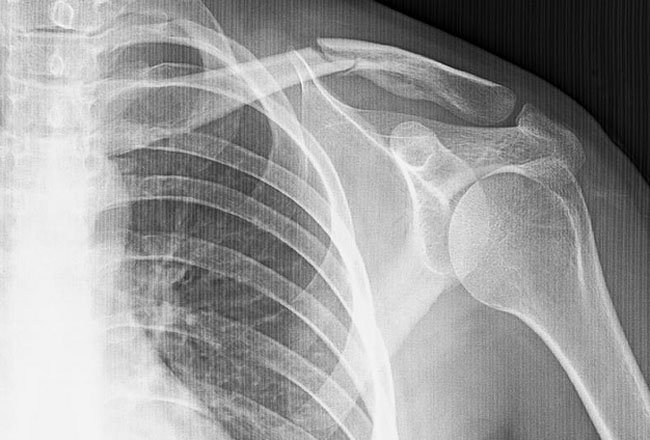 FRACTURA DE CLAVICULA – Blog de Fisioterapia