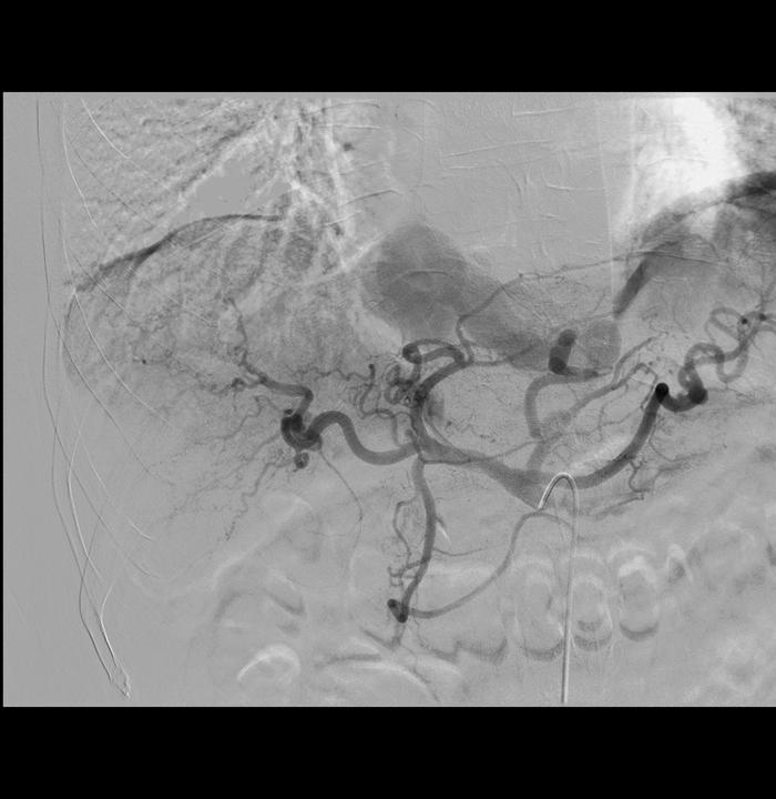 Left Gastric Artery Angiogram