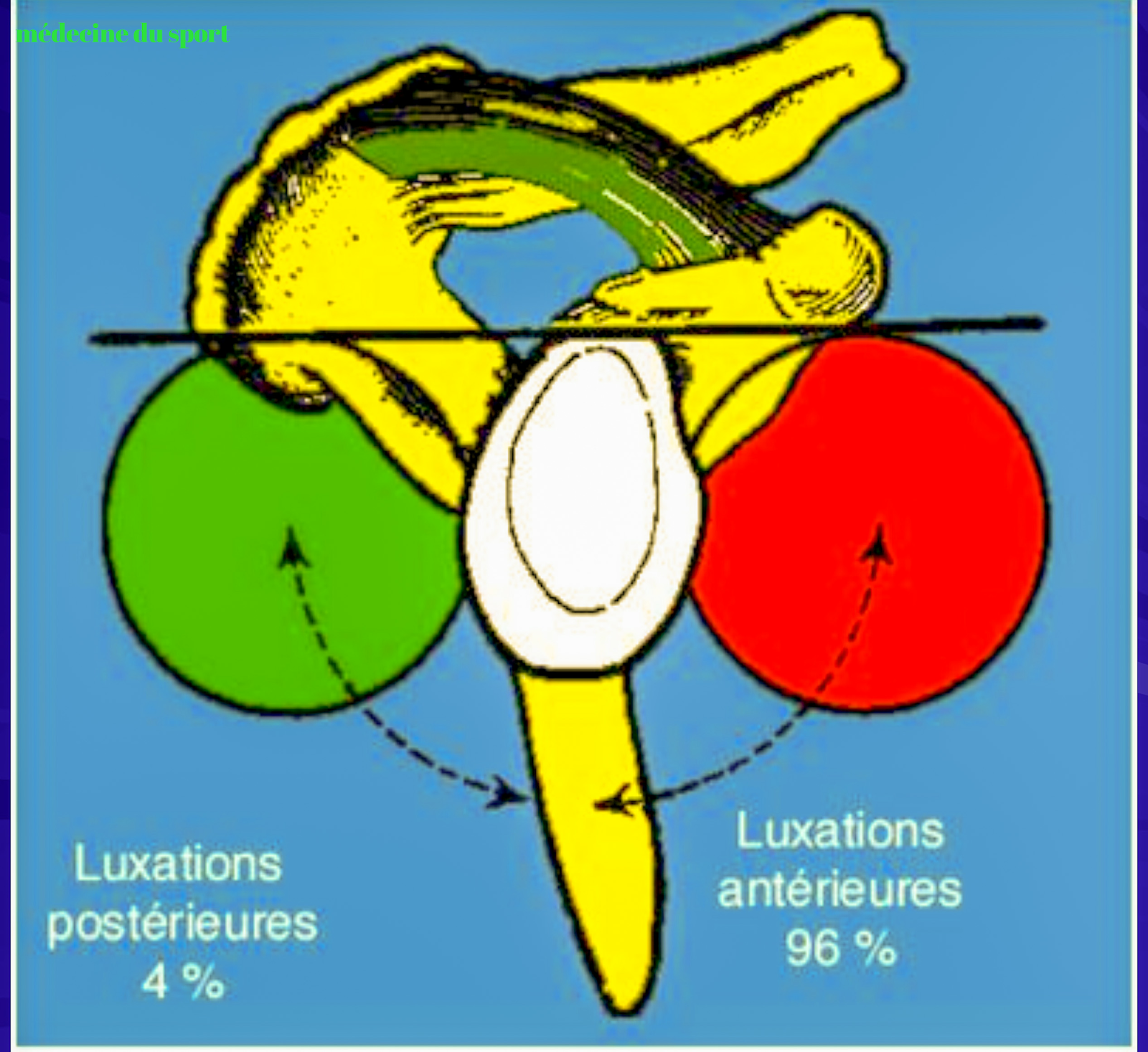 Les Luxations de l’épaule
