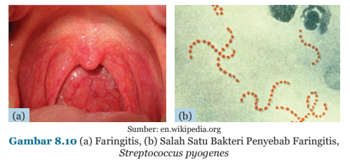 Gangguan pada Sistem Pernapasan Manusia