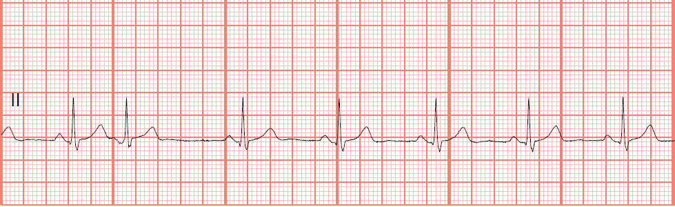 EKG Quiz 336