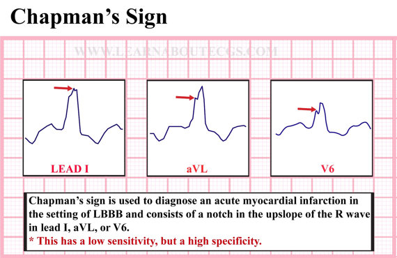 Chapman's Sign | INA - ECG