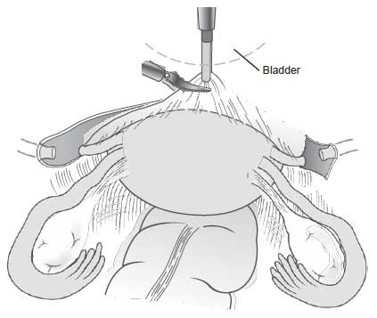 Total Laparoscopic Hysterectomy Case File