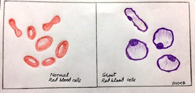 GLAUCOMA SPECIALIST BLOG: "THE GLOG"