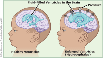 Hydrocephalus: It's All In Your Head