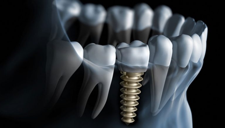 DENTAL IMPLANTS - Dental Implant
