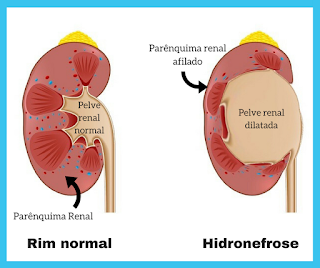 Dra Desirée Nefropediatra: Hidronefrose Fetal