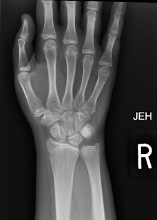 Early Action in Madelungs Deformity | Congenital Hand and Arm ...