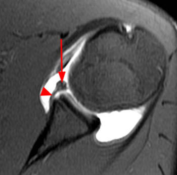 MRI Musculo-Skeletal Section: Labrum