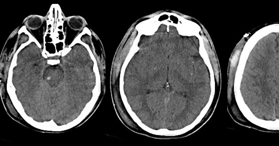 Dr Balaji Anvekar FRCR: Diffuse Axonal Injury CT Brain