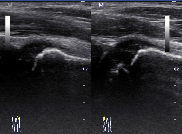 EcoCyl-Msk: Sinovitis transitoria de cadera