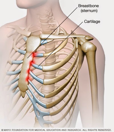 Osteopathy: 5 Fact To Know About Costochondritis