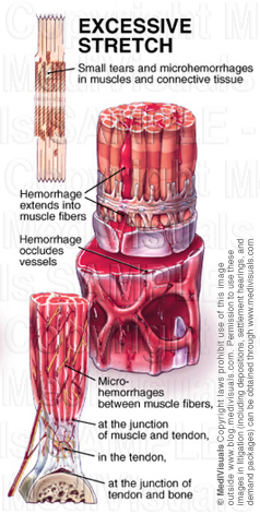 The Medical Legal Exhibit Expert Blog: Soft Tissue Injury - Cervical ...