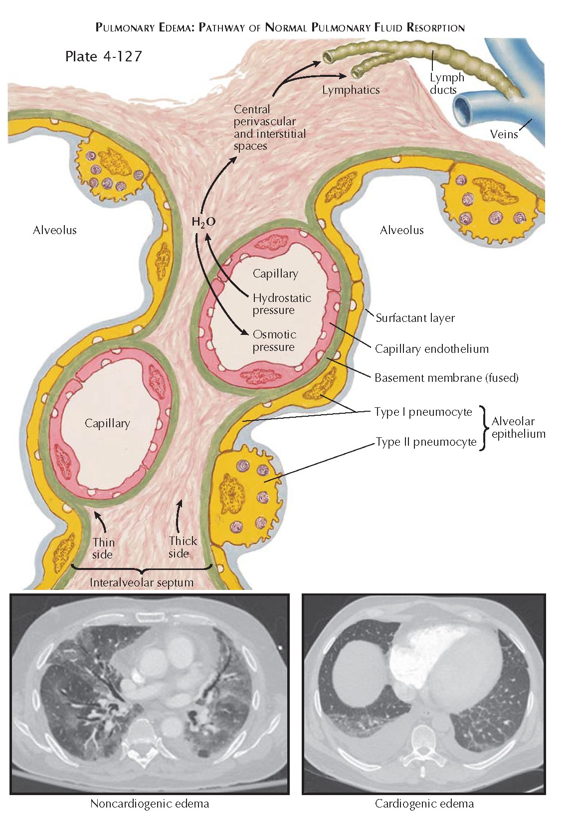 PULMONARY EDEMA - pediagenosis