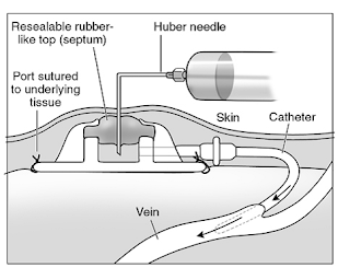 USF BREAST HEALTH: About Your Port