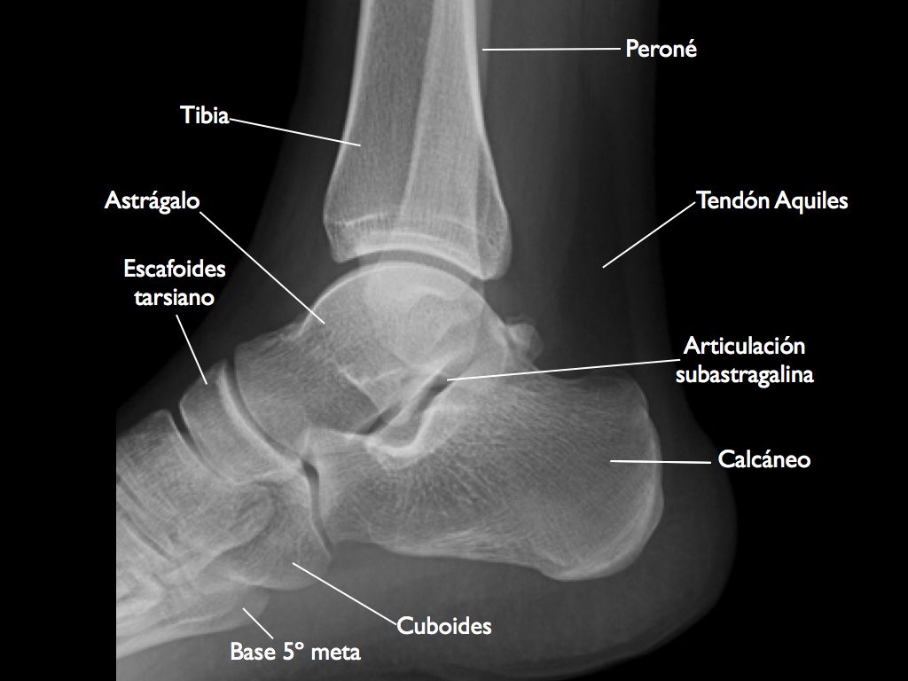 NOSOLOTECNICOS: LATERAL DE TOBILLO