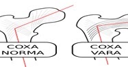 coxa-valga-norma-vara.jpg