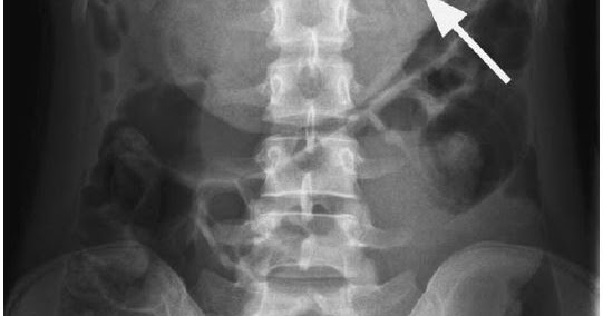 Bezoar – Xray, Barium Studies, and CT Scan Examination - RadTechOnDuty