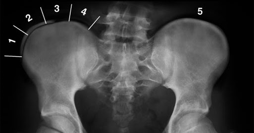 整形外科 論文ナナメ読み （JBJSなどなど）: 20160807 JBJS（Am) The effect of Risser stage ...