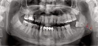 Medical Treatment Pictures-for Better Understanding: Mylohyoid Ridge ...