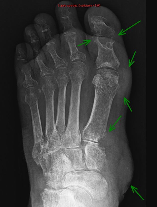 Chronic Tophaceous Gout.