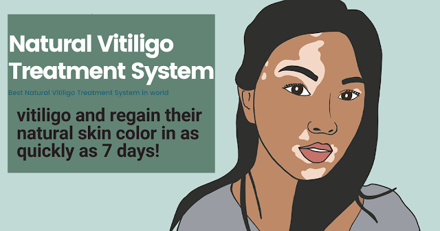 Natural Vitiligo Treatment System : The best natural treatment system for vitiligo - Sphere ...