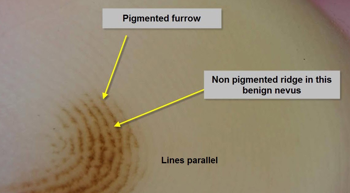 Dermoscopy Features as Clues: Lines Parallel