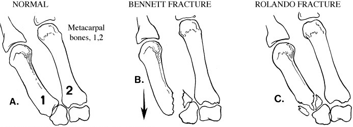 Eponymous fractures of Upper limb
