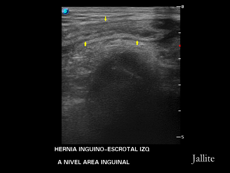 Hernia Inguino-Escrotal Incarcerada