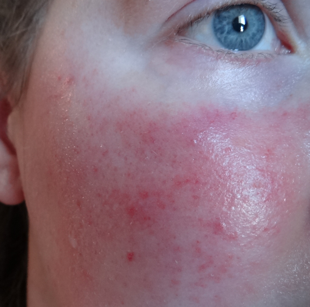 Scarlet Letters, dealing with vascular rosacea, face flushing, burning ...
