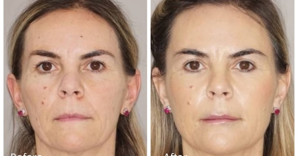 Plastic and Cosmetic Surgery: Micro Fat Transfer: A Non-Surgical ...