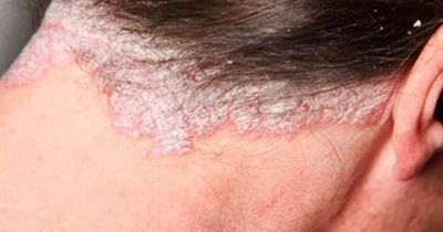 Obat gatal alami: penyakit dermatitis seboroik