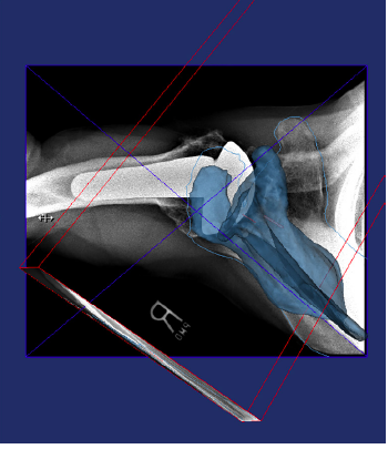 UW Shoulder and Elbow Academy: Glenoid version - measurement and ...