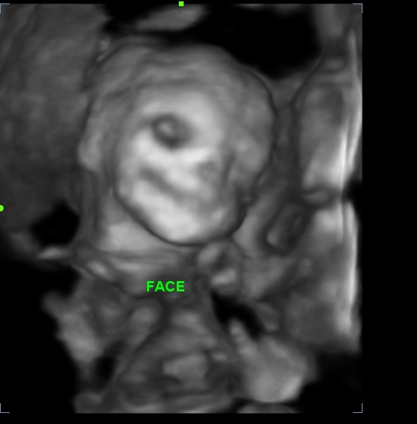 BANGALORE ULTRASOUND BLOG: 3D/4D scan for pregnancy