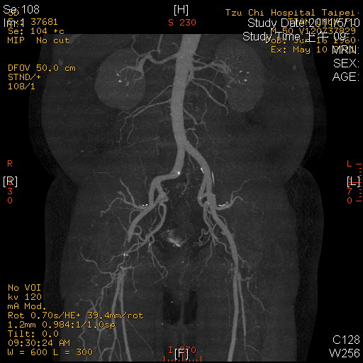 淨元法師之大醫院小醫師: right CFA saddle thrombus status post type A dissection ...