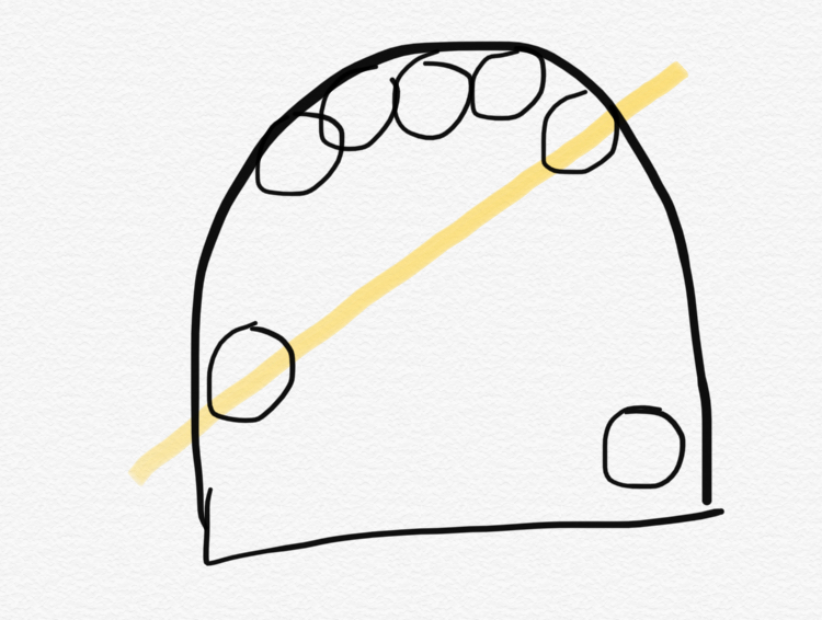 Dentowesome: Fulcrum Lines in RPD