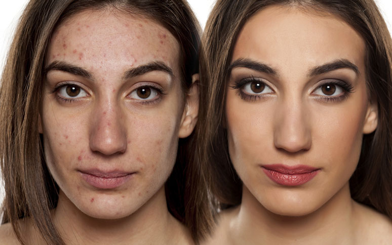 What is acne and how it can be treated?