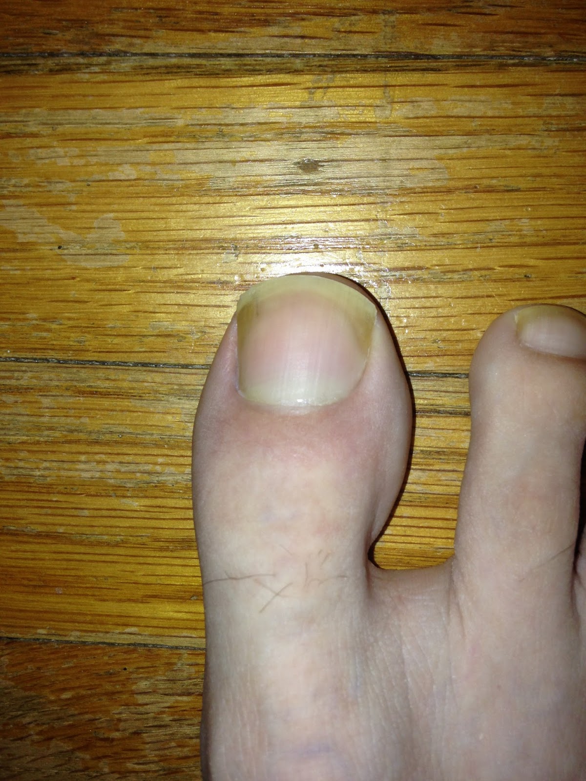 Foot and Ankle Problems By Dr. Richard Blake: Toenail Fungus begins to ...