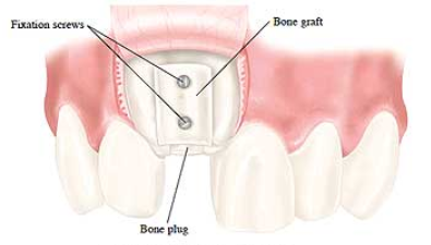 Bone Graft, Sinus Lifts & More