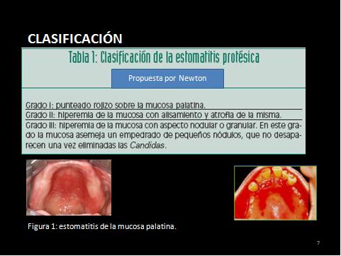 PROSTODONCIA TOTAL: Estomatitis protesica