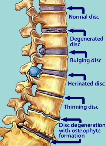 Acupressure for back pain