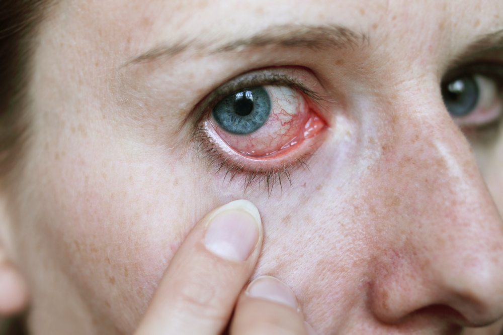 Preventing Red Eye and Infection Associated with Swimming Pools ...