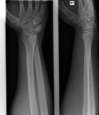 El Cuerpo Humano: El cúbito